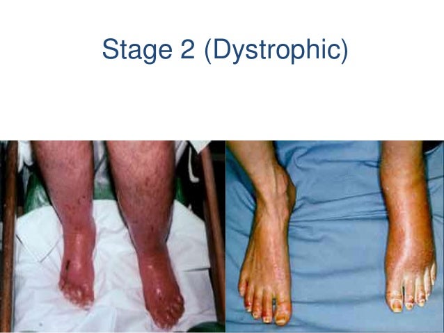 complex regional pain syndrome. C.R.P.S