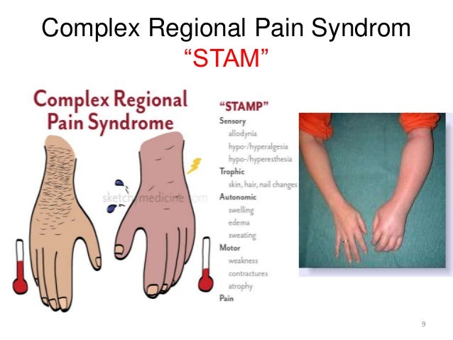 complex regional pain syndrome. C.R.P.S