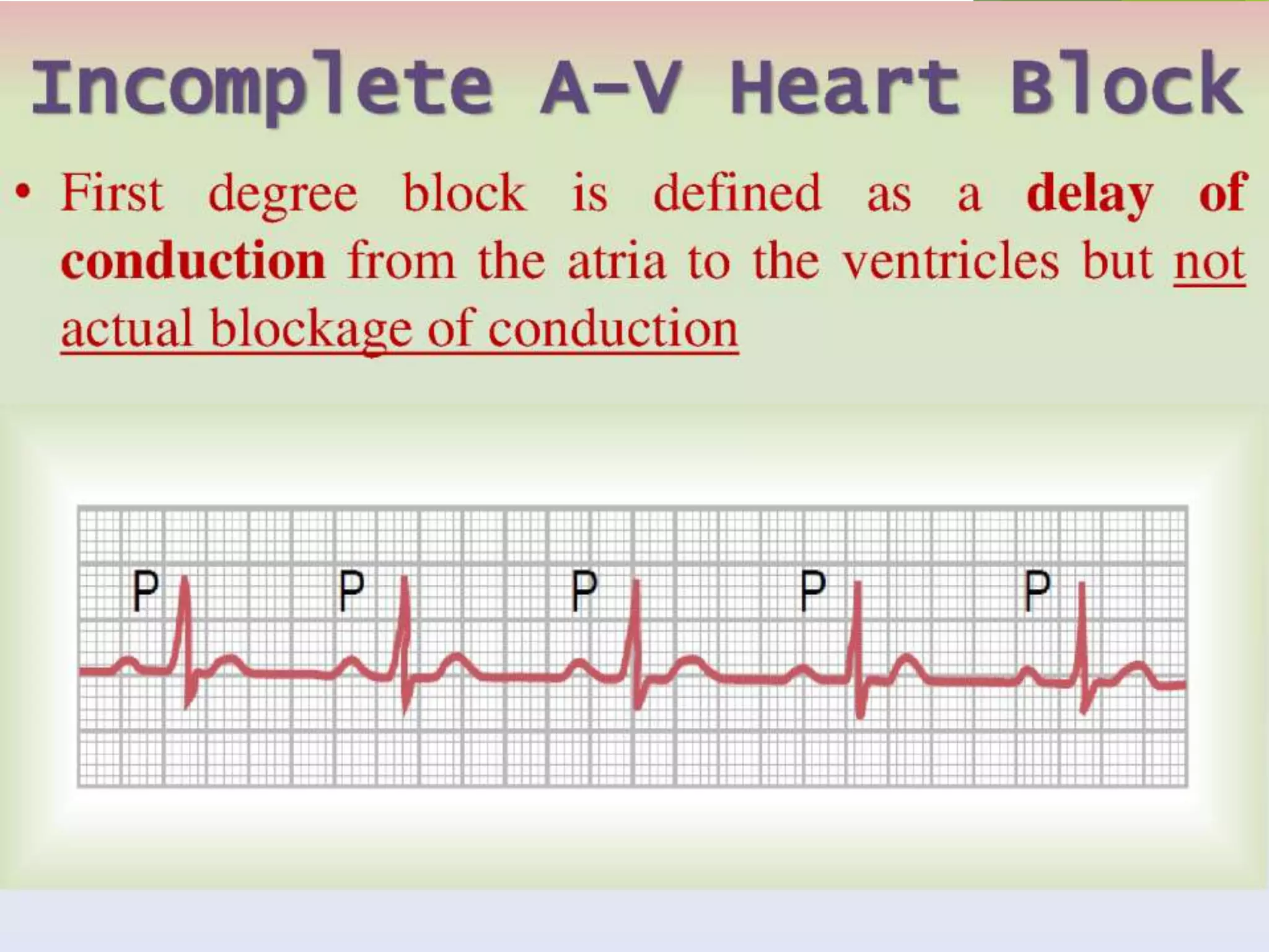 heart block presentation (1) | PPTX