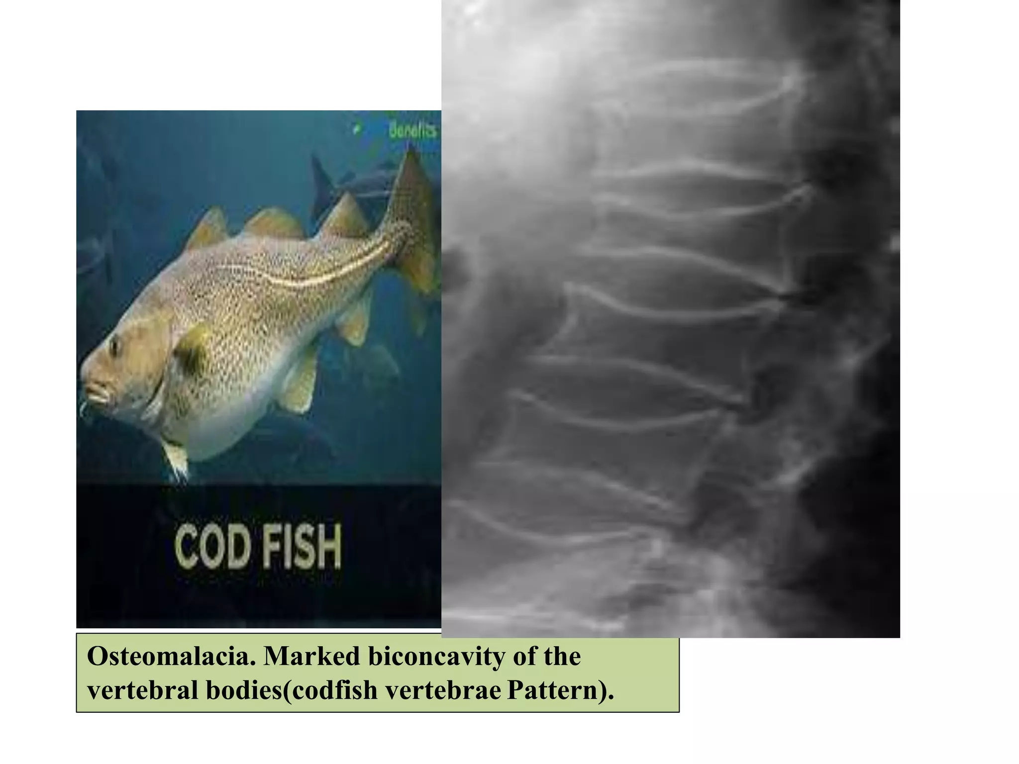 Metabolic Bone Diseases - RAVI | PPTX