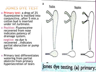 DACROCYSTORHINOSTOMY(D.C.R.)by dr.ravindra | PPTX