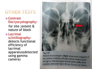 DACROCYSTORHINOSTOMY(D.C.R.)by dr.ravindra | PPTX