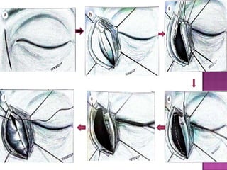 DACROCYSTORHINOSTOMY(D.C.R.)by dr.ravindra | PPTX