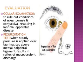 DACROCYSTORHINOSTOMY(D.C.R.)by dr.ravindra | PPTX