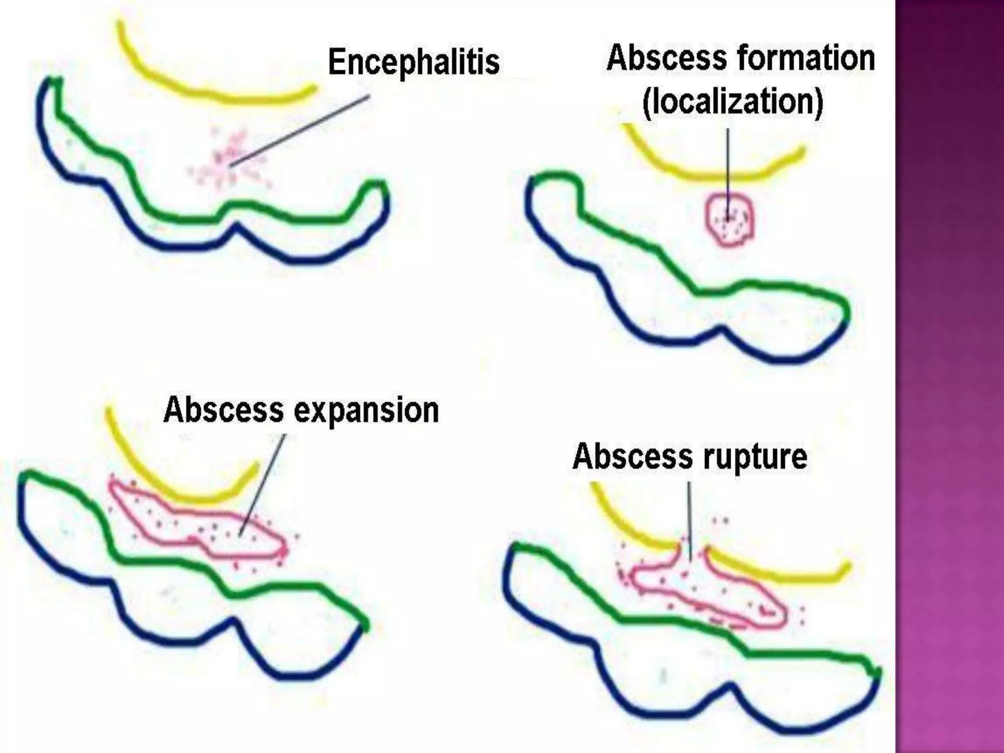 OTOGENIC BRAIN ABSCESS by dr.ravindra | PPTX