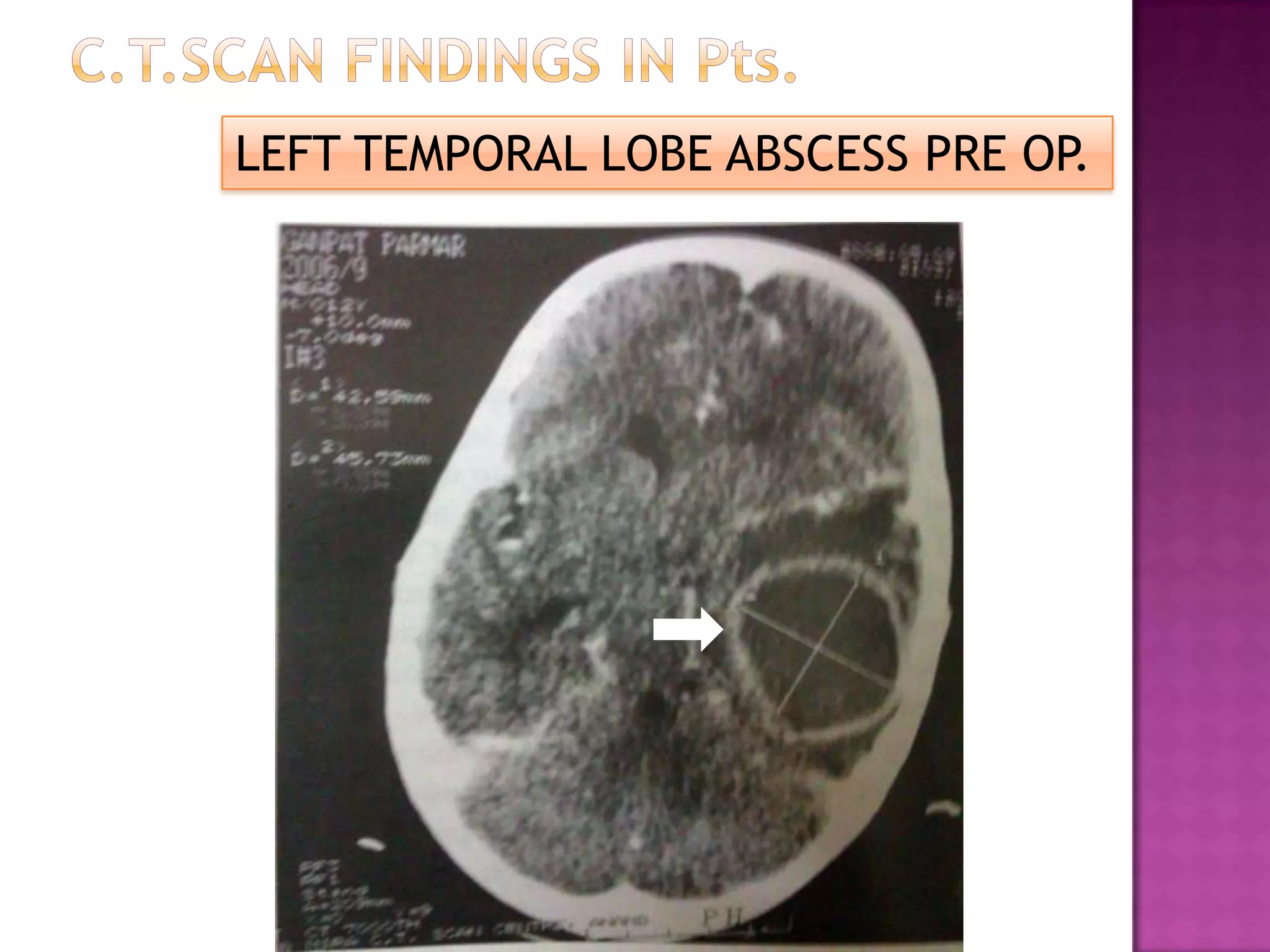 OTOGENIC BRAIN ABSCESS by dr.ravindra | PPTX