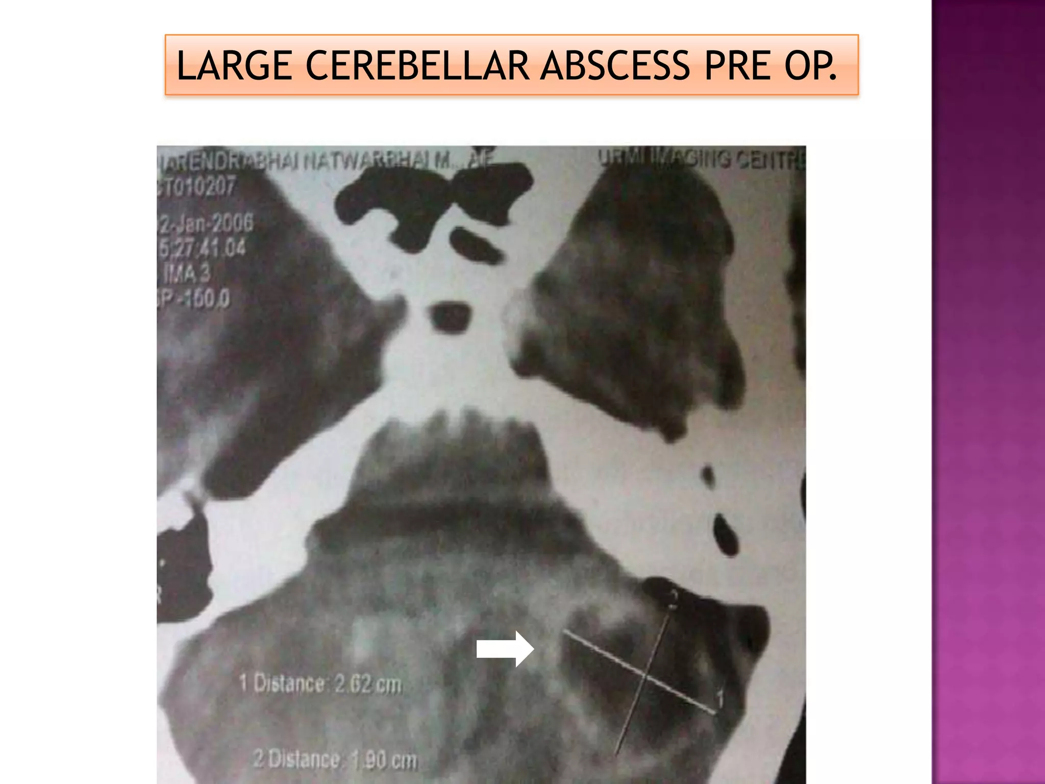 OTOGENIC BRAIN ABSCESS by dr.ravindra | PPTX