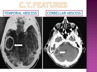OTOGENIC BRAIN ABSCESS by dr.ravindra | PPTX
