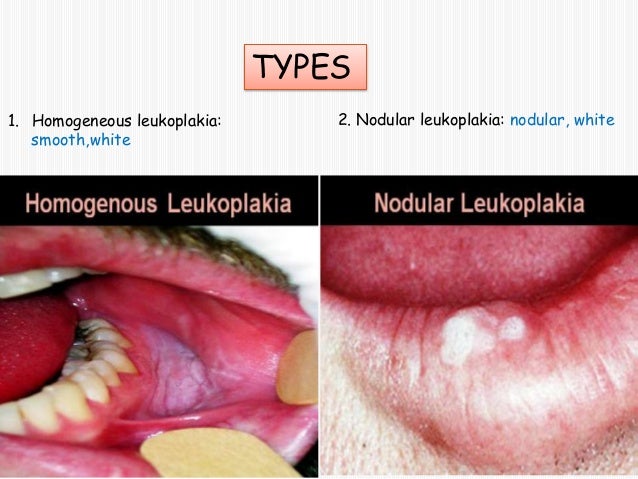 common oral lesions by ravindra daggupati