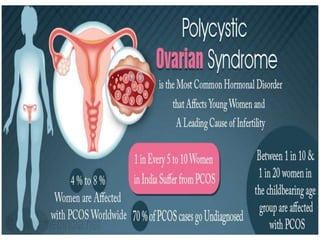 PCOD | PPT