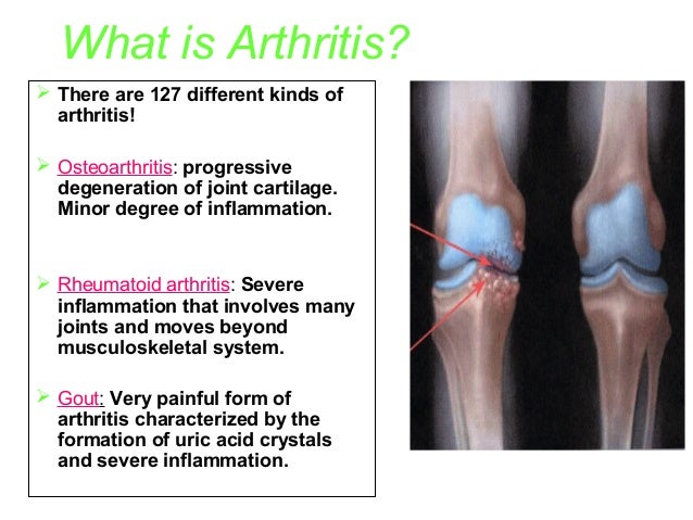 RHEUMATOID ARTHRITIS VK rheumatoid-arthritis-vk