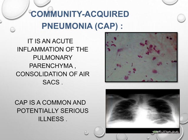 CAP (Community Acquired Pneumonia ) | PPTX | Lung and Respiratory ...
