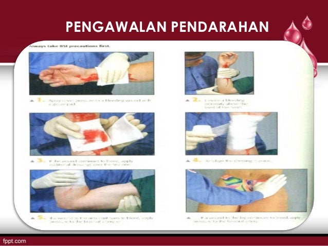 Rawatan perdarahan
