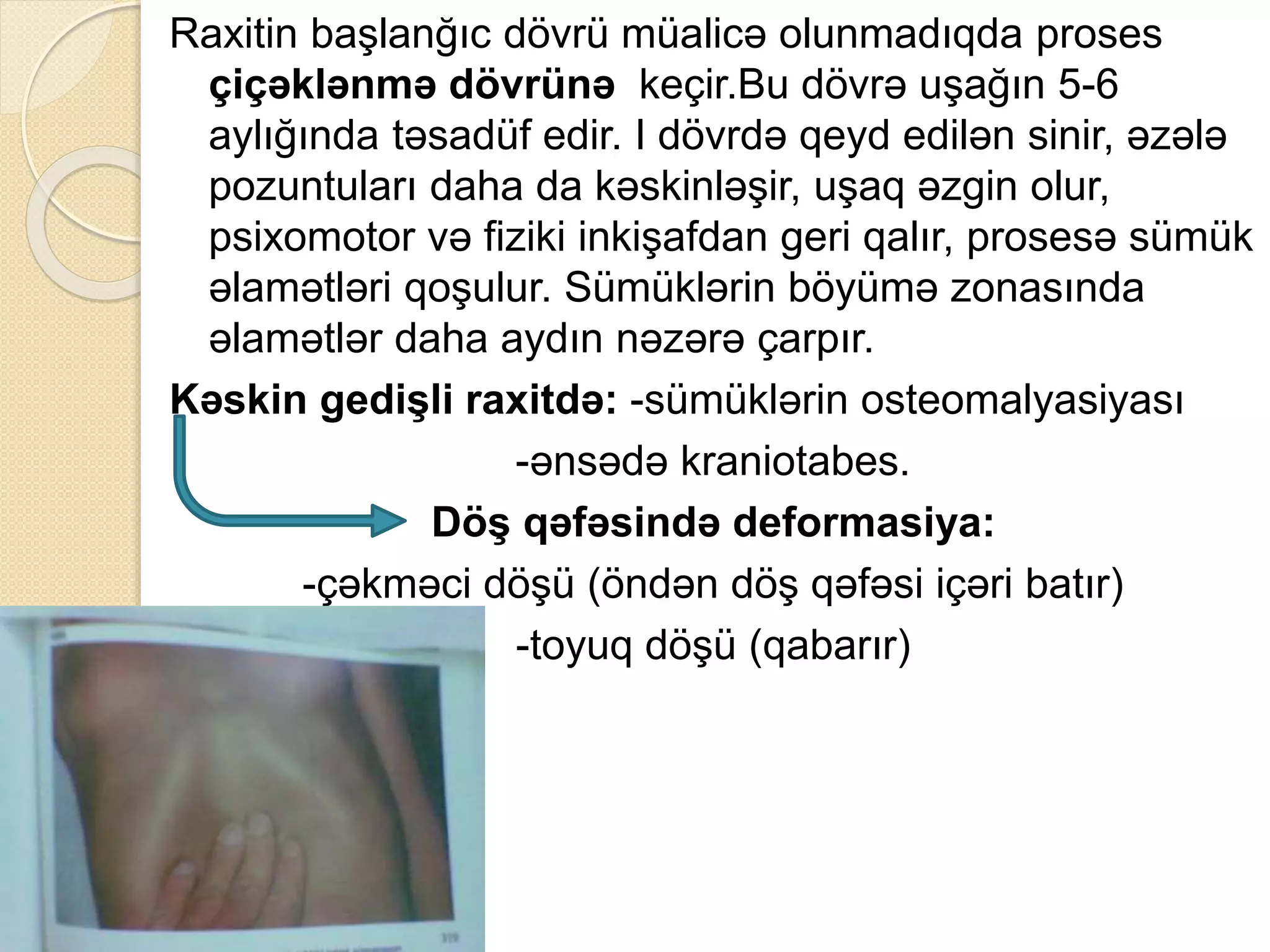 Raxit xəstəliyi (Rachitis) | PPTX