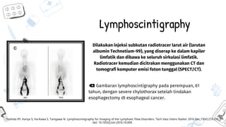 RAY - chylothorax.pptx