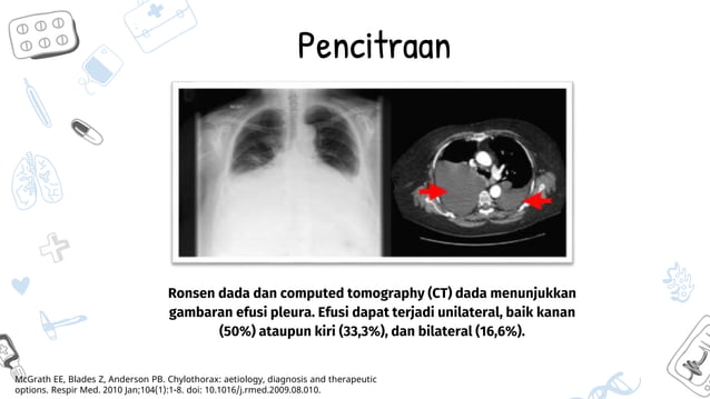 RAY - chylothorax.pptx