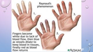 Raynaud | PPTX
