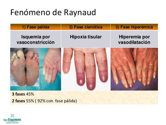 Raynaud