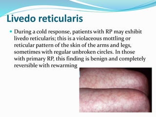 Raynaud phenomenon | PPTX | Blood Disorders | Diseases and Conditions