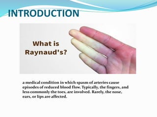 Raynaud phenomenon | PPTX