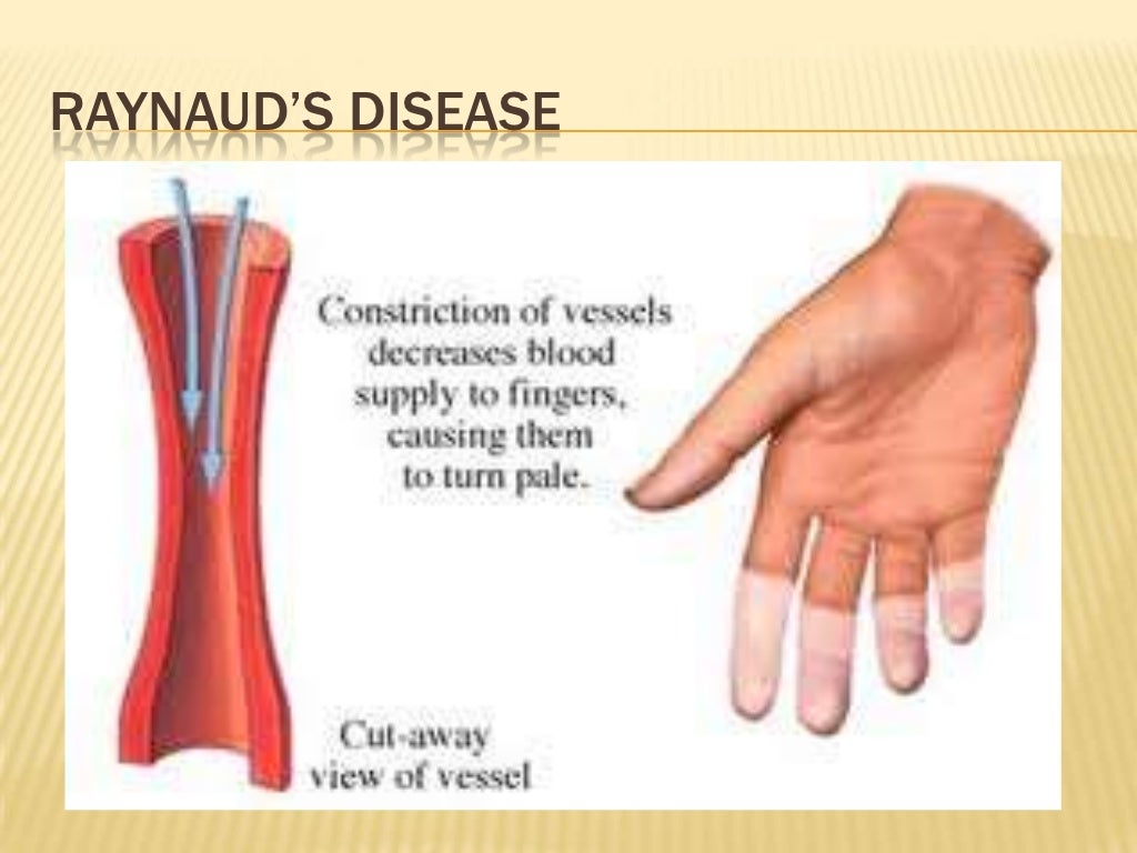 Raynaud’s