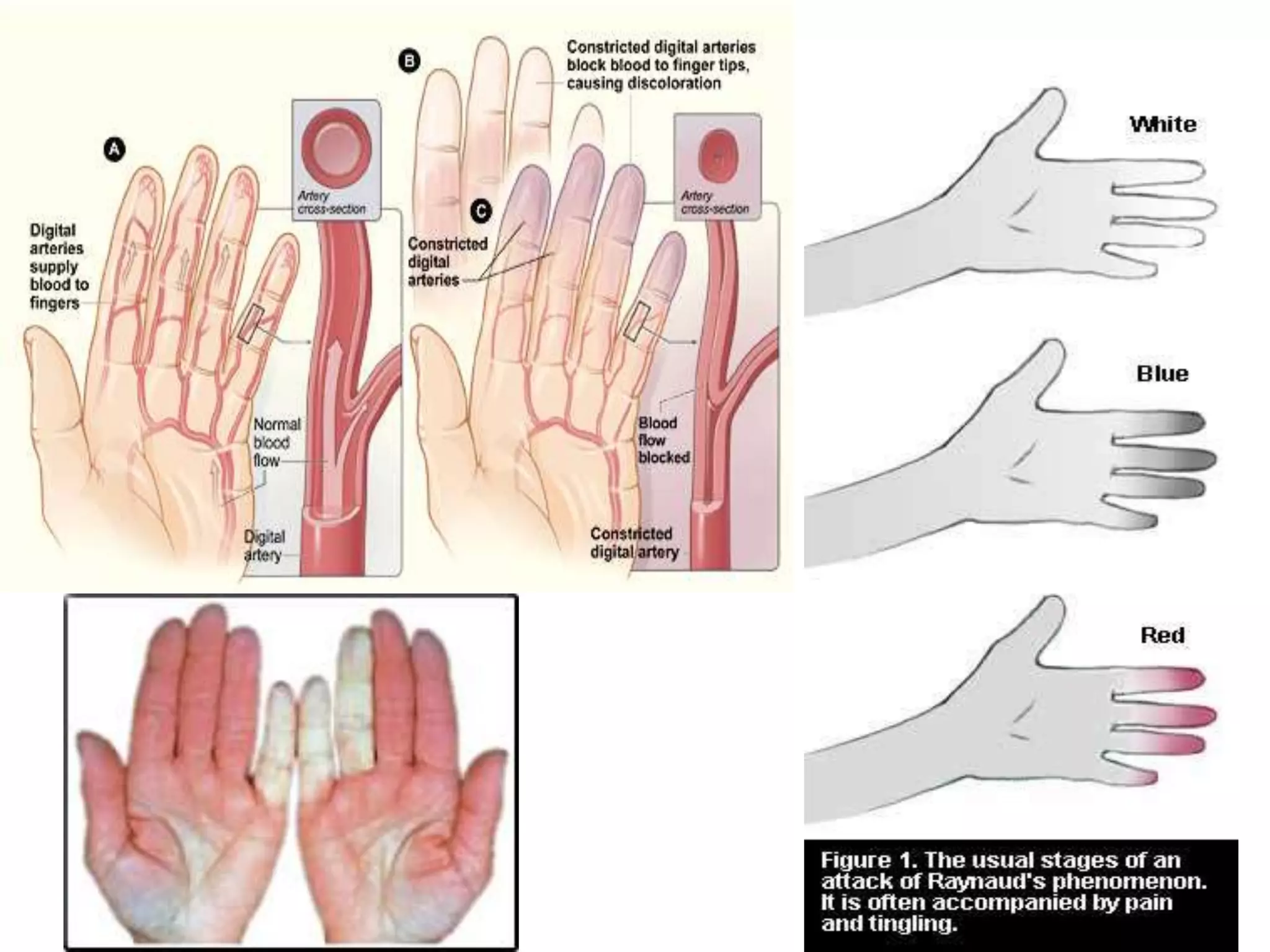 Raynaud's-Disease.ppt