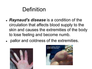 Raynaud's-Disease.ppt