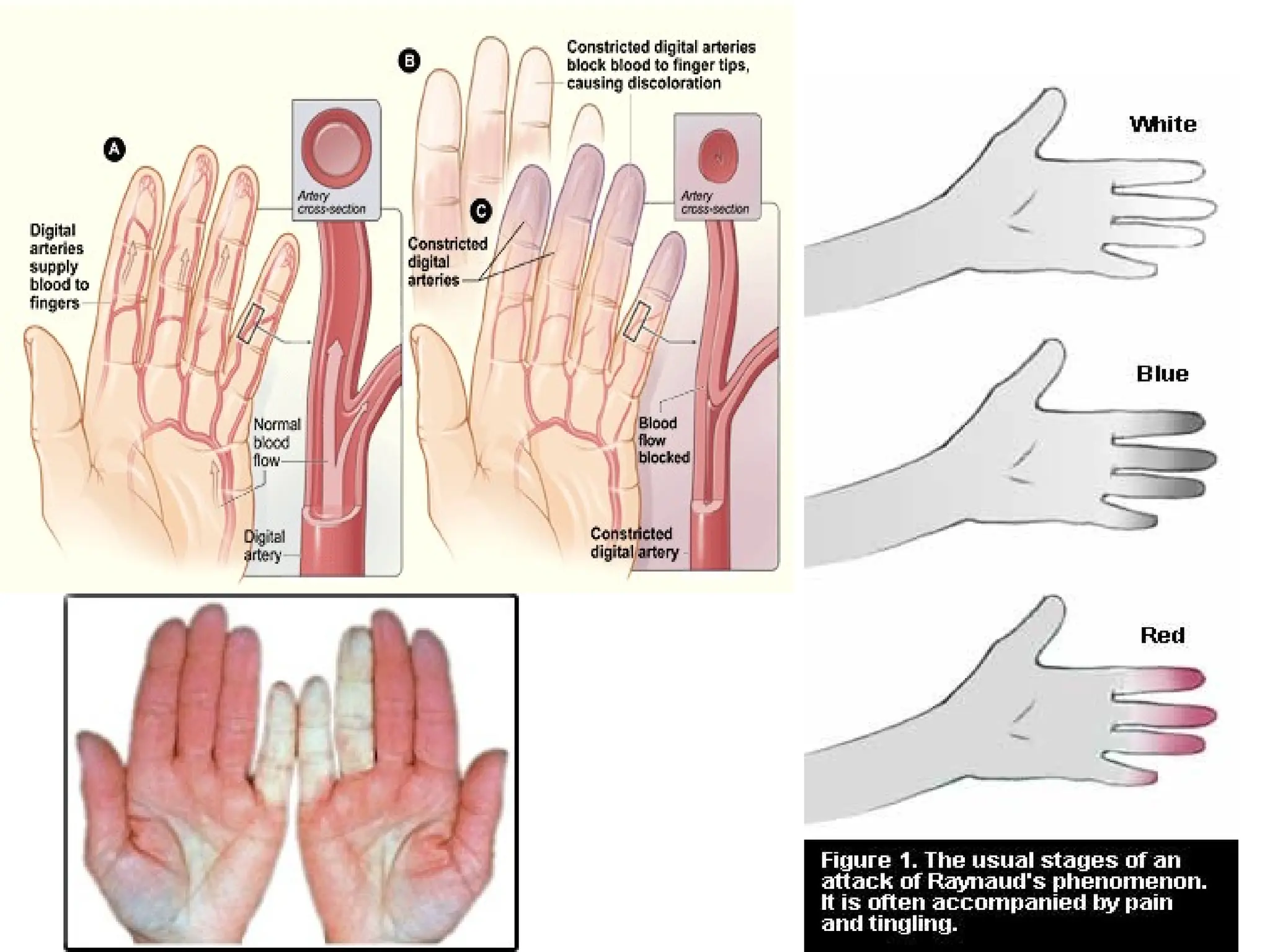 Raynaud's Disease presentation in detail | PPT