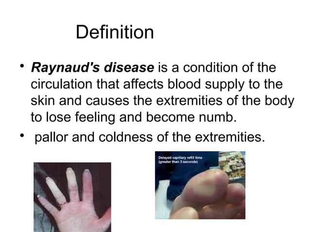 Raynaud's Disease presentation in detail | PPT