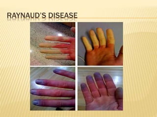 Raynauds phenomenoa | PPT