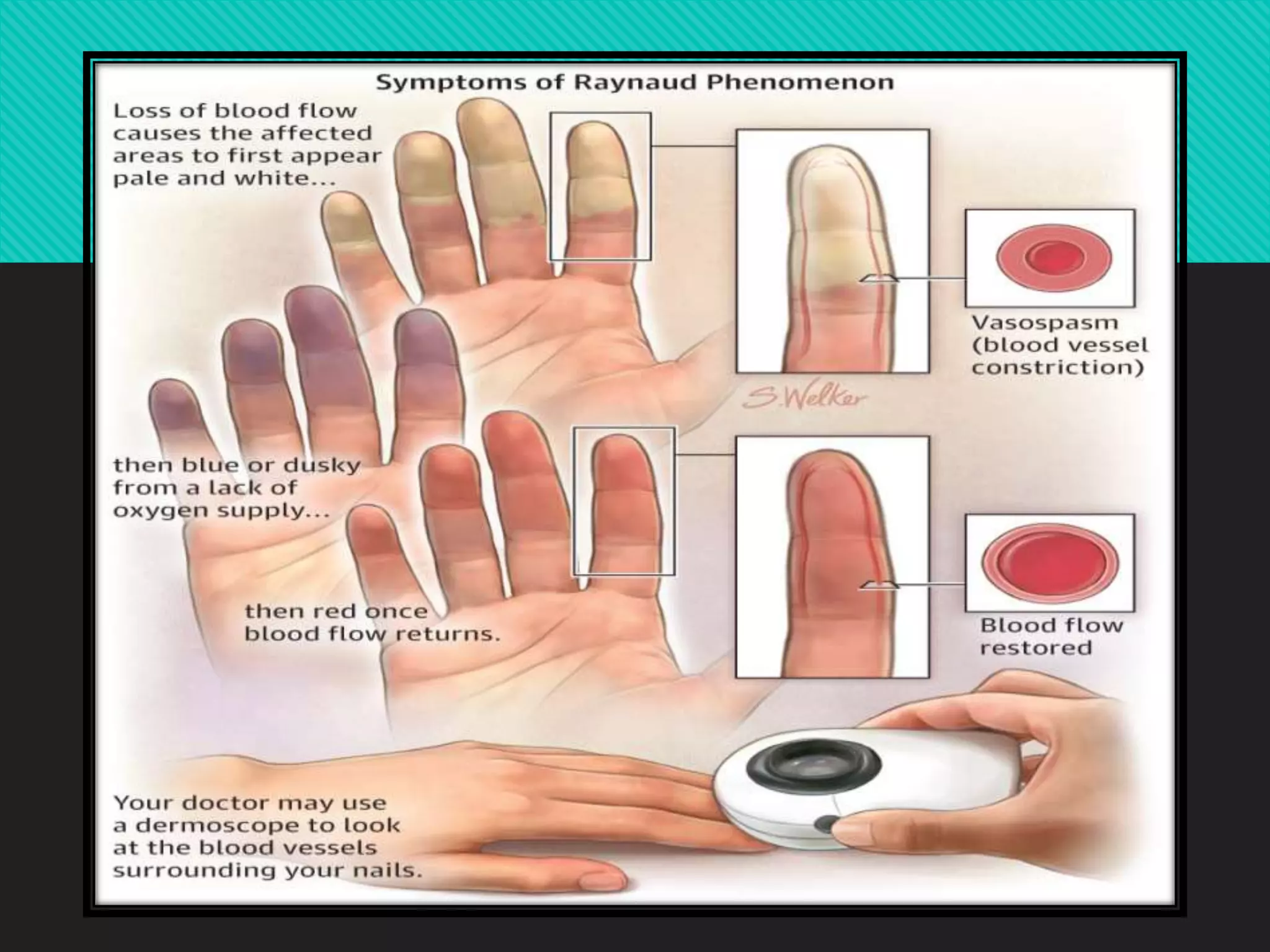 Nursing management Of patients with Raynaud's disease | PPTX