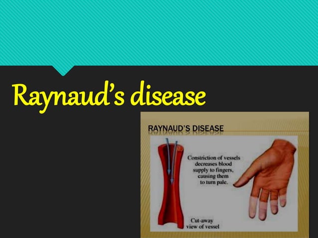 Nursing management Of patients with Raynaud's disease | PPTX | Blood ...