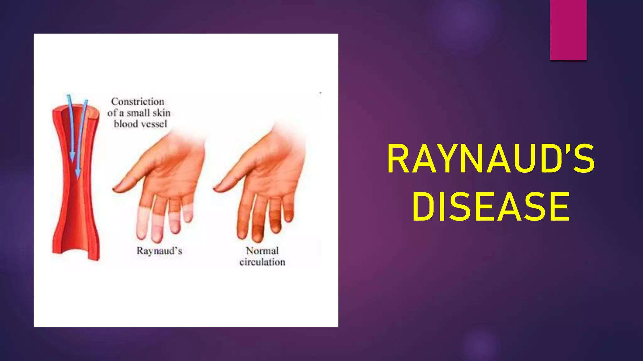 RAYNAUD'S DISEASE | PDF