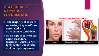 RAYNAUD'S DISEASE | PDF