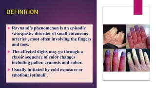 RAYNAUD'S DISEASE | PDF
