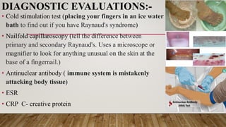 Raynaud's disease.pdf