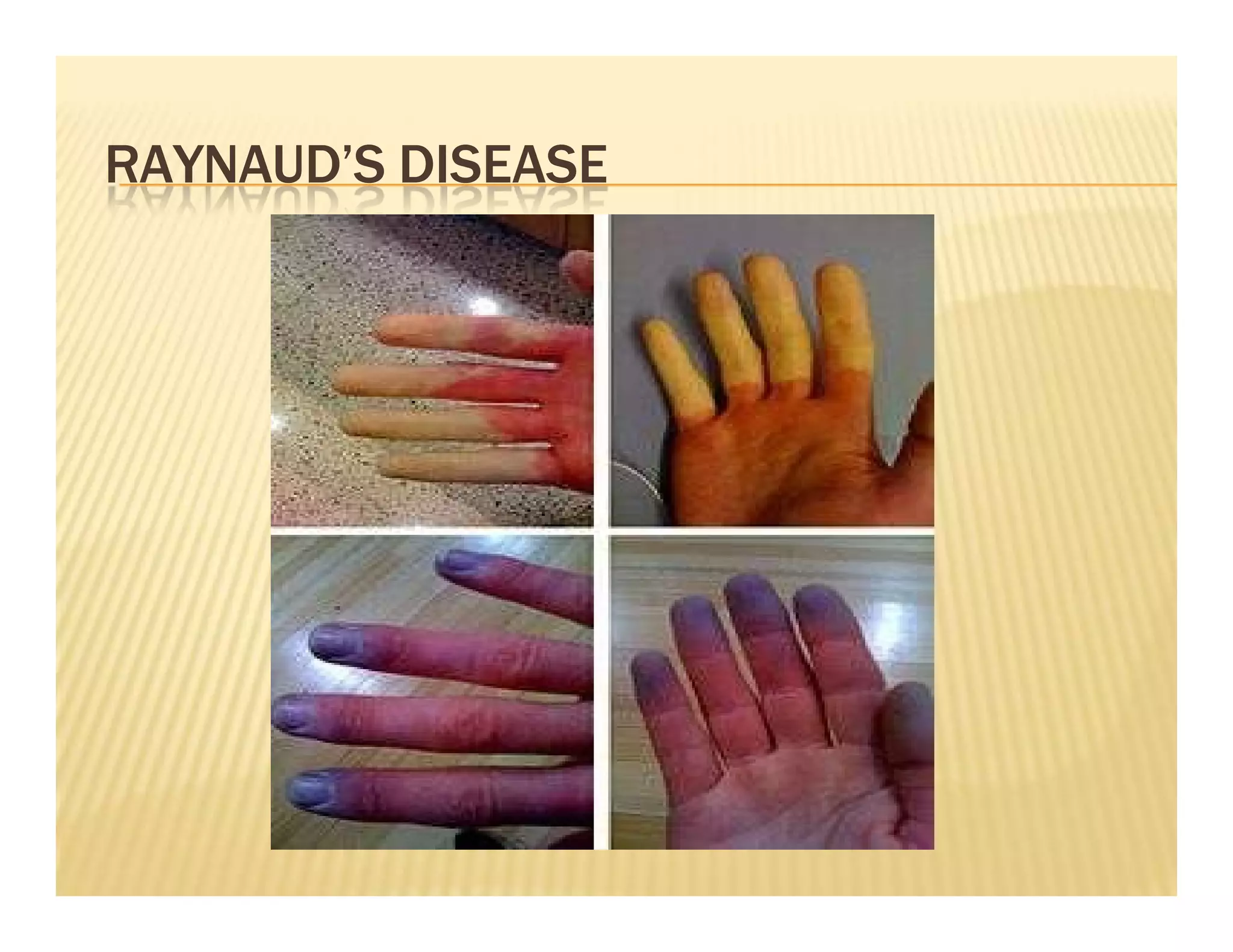 Raynauds disease By_A. Raju_Yadav | PDF