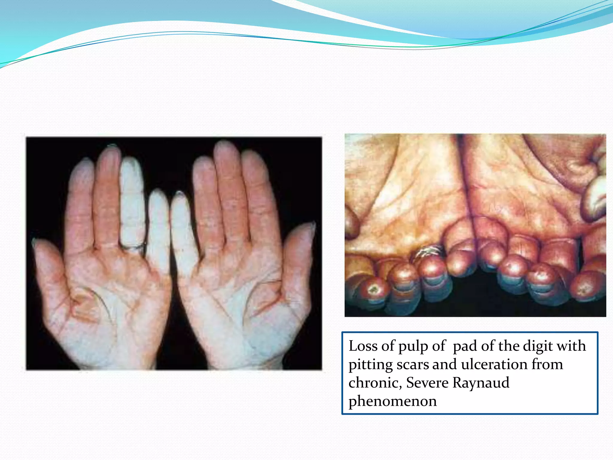 Raynaud's phenomenon | PPTX