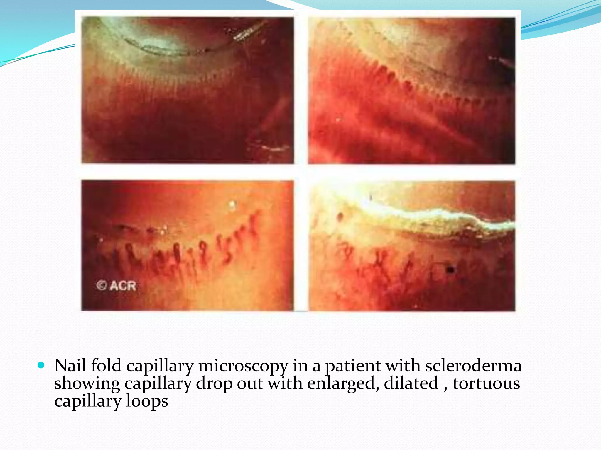 Raynaud's phenomenon | PPTX