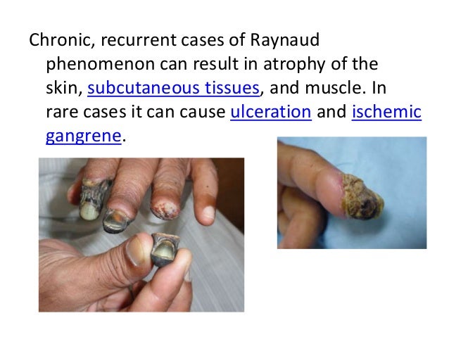 Raynauds Phenomenon