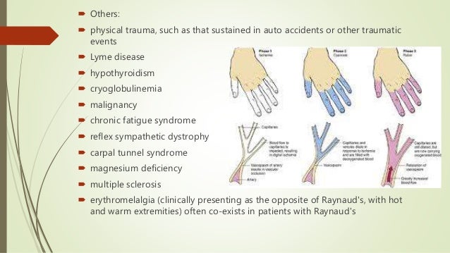 Raynaud's phenomenon