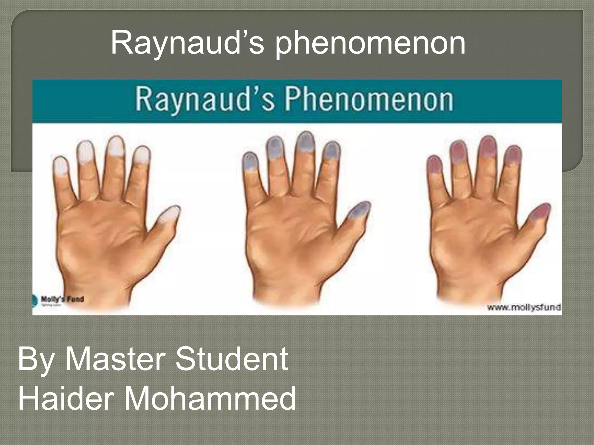 Raynaud’s phenomenon | PPTX