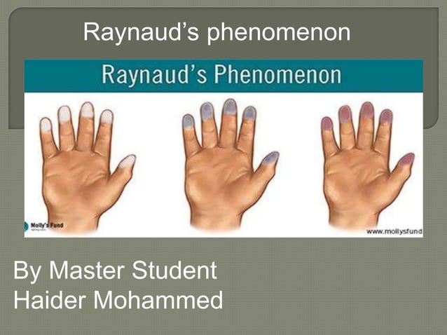 Raynaud’s phenomenon | PPT
