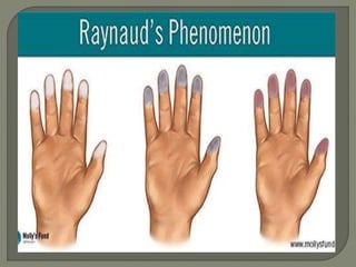 Raynauds Phenomenon-Dignosis & Evaluation | PPTX