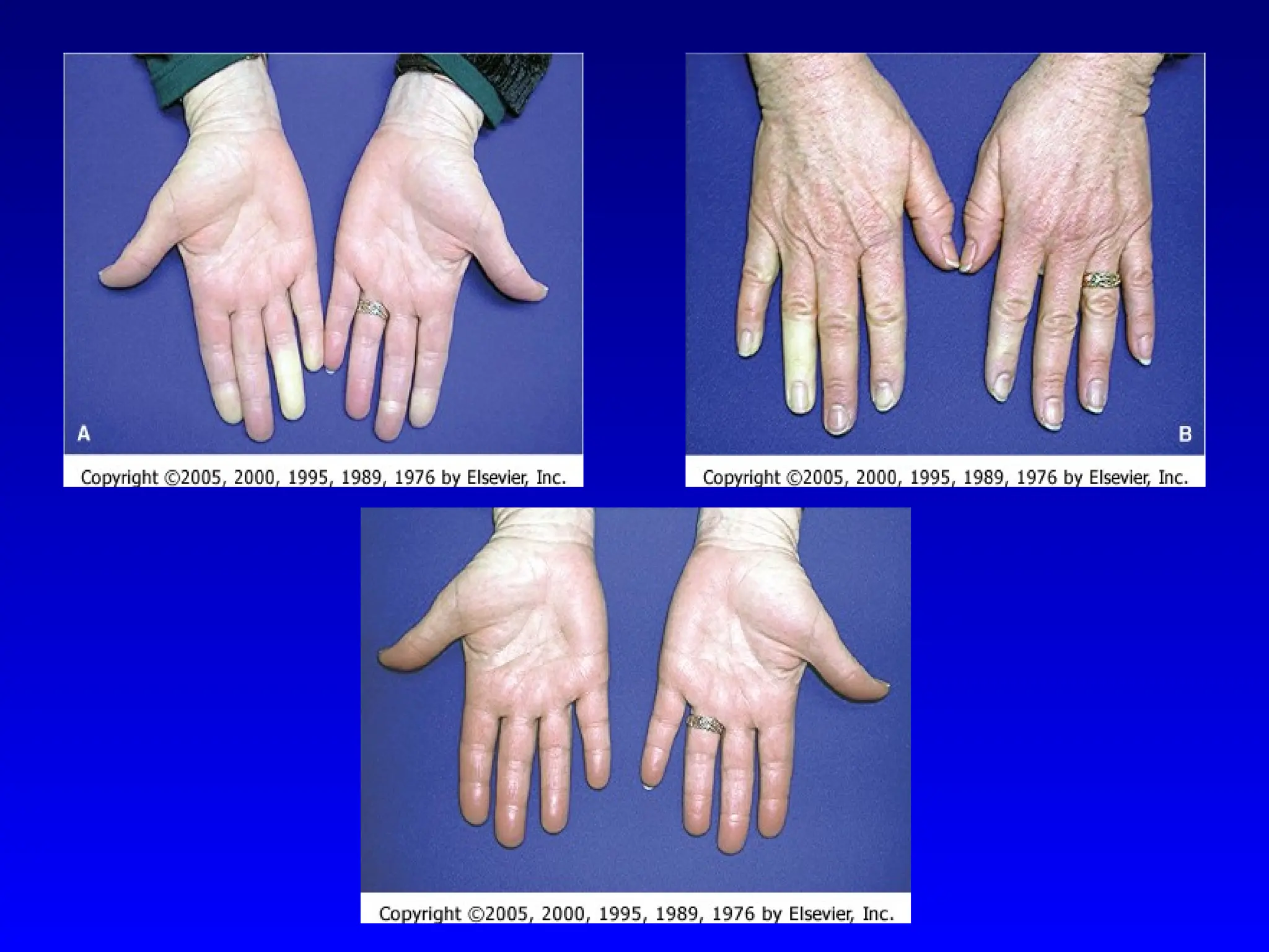 raynaud's syndrome topic from clinical pharmacy | PPT