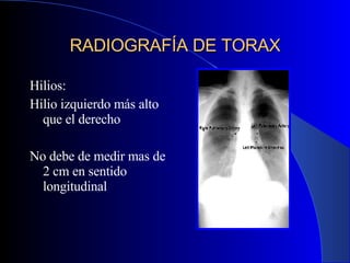 Rayos x de torax | PPT