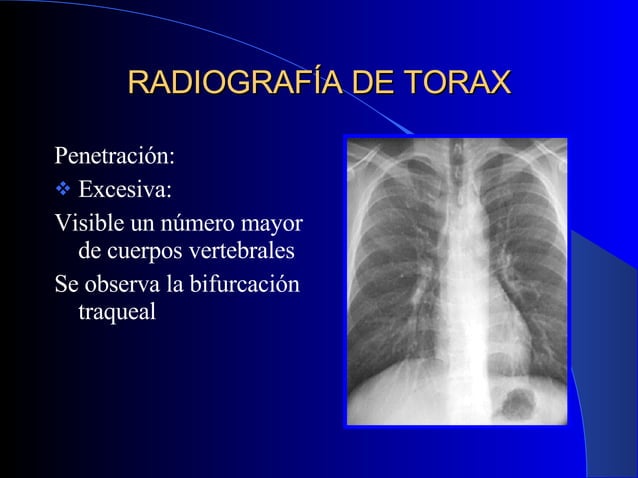 Rayos x de torax