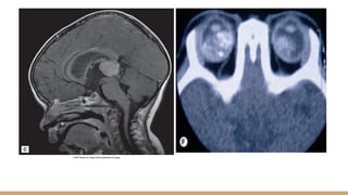 Retinoblastoma: Diagnosis and Treatment(Local and systemic therapy) | PPTX