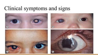 Retinoblastoma: Diagnosis and Treatment(Local and systemic therapy) | PPTX