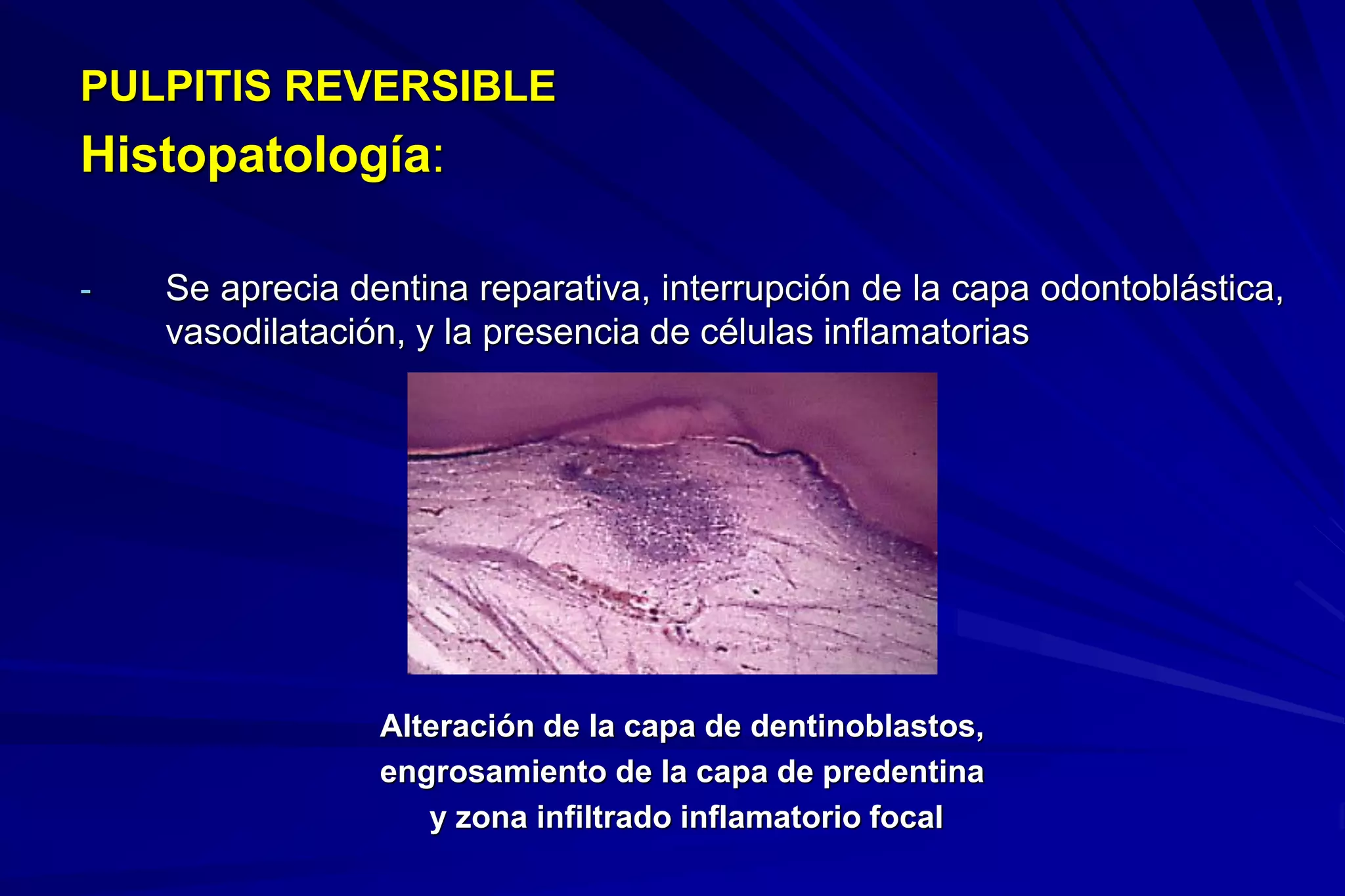 Alteraciones pulpares y periapicales | PDF